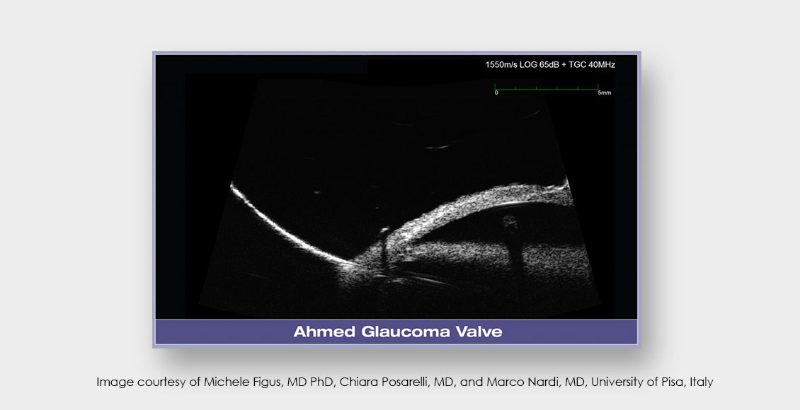 Ellex Eye Cubed™ Ophthalmic Ultrasound