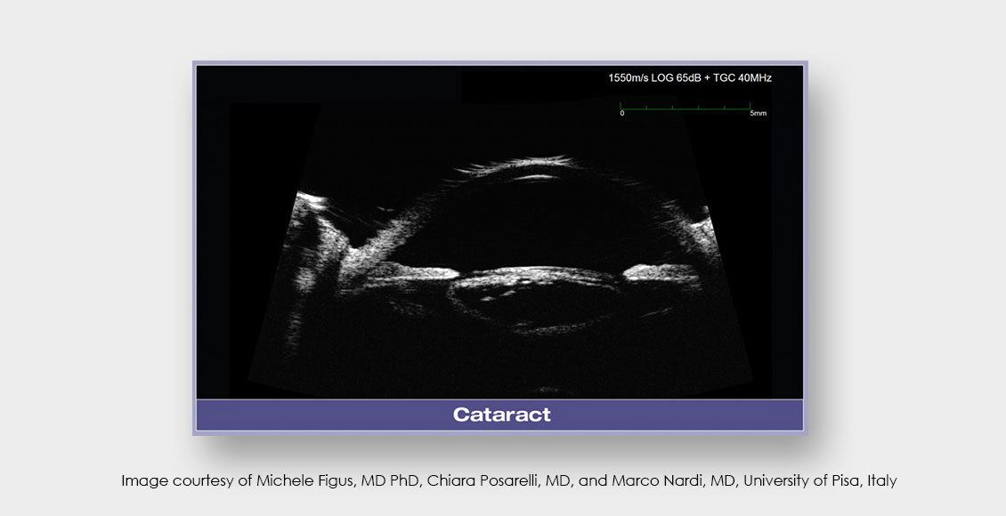 Ellex Eye Cubed™ Ophthalmic Ultrasound