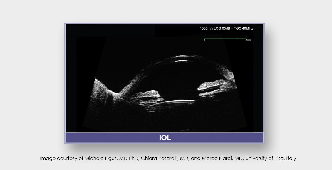 Ellex Eye Cubed™ Ophthalmic Ultrasound