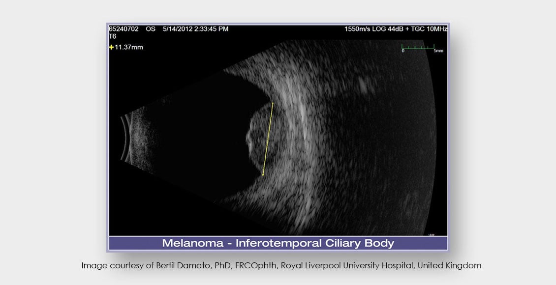 Ellex Eye Cubed™ Ophthalmic Ultrasound