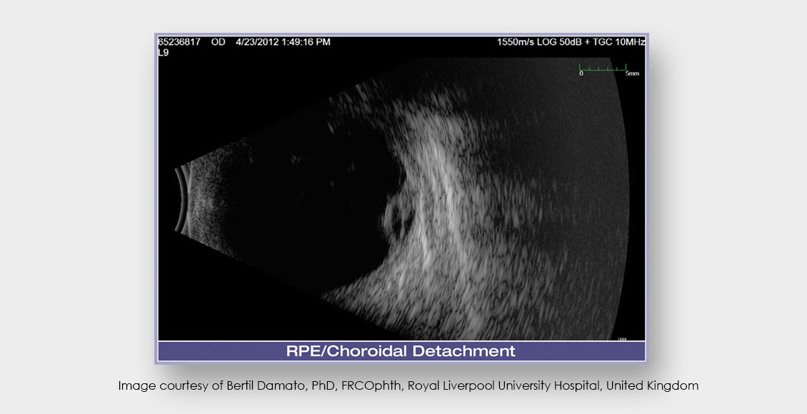 Ellex Eye Cubed™ Ophthalmic Ultrasound